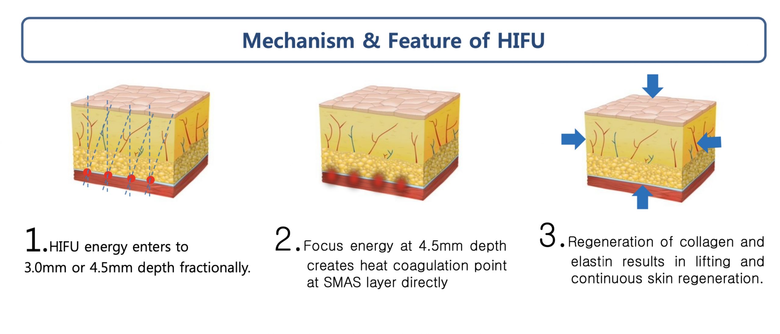 High Intensity Focused Ultrasound (HIFU) | Bright Clinic